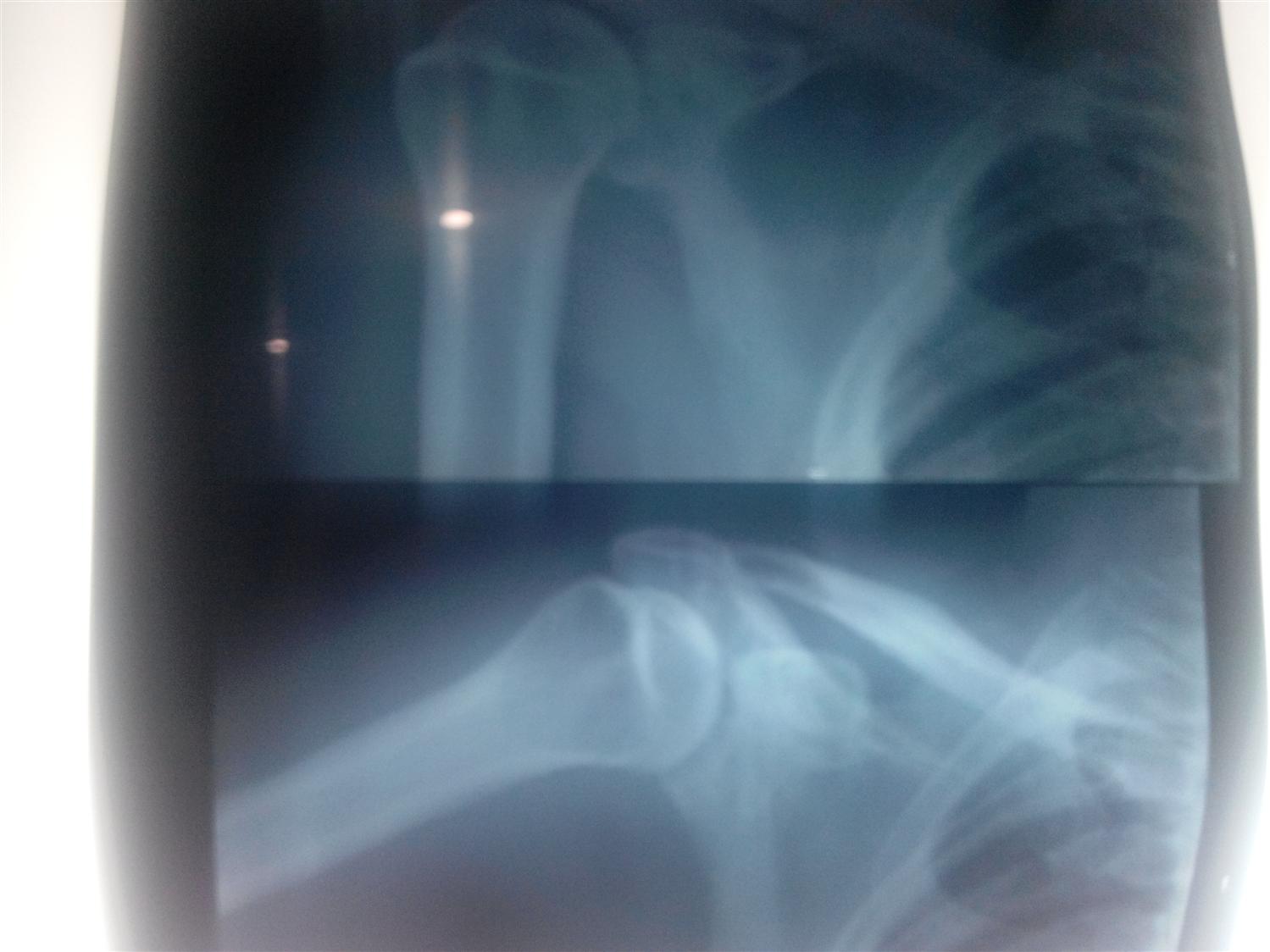 Normal Bone Metabolism Basic Science Orthobullets Articular Cartilage